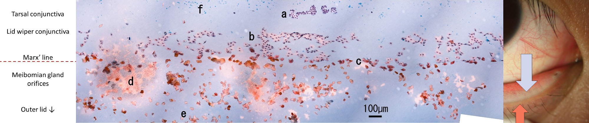 Impression Cytology of the Lid Wiper Area - PMC