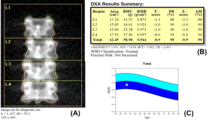 Scanning Skeletal Remains for Bone Mineral Density in Forensic Contexts