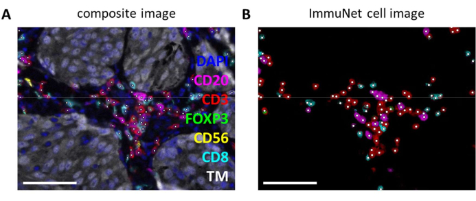 Multiplex Immunohistochemical Analysis of the Spatial Immune Cell ...