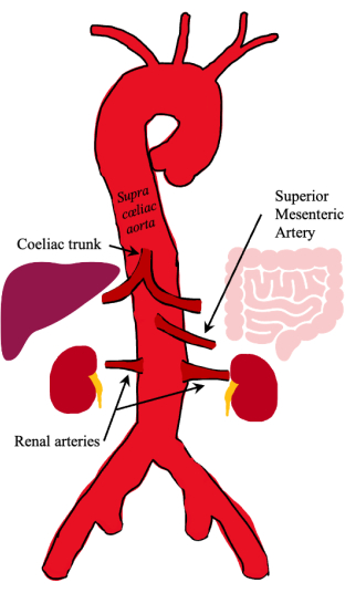 A Model of Acute Lung Injury Following Visceral Ischemia-Reperfusion by ...