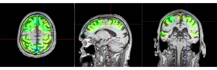 Transcranial Pulse Stimulation for Alzheimer's Patients