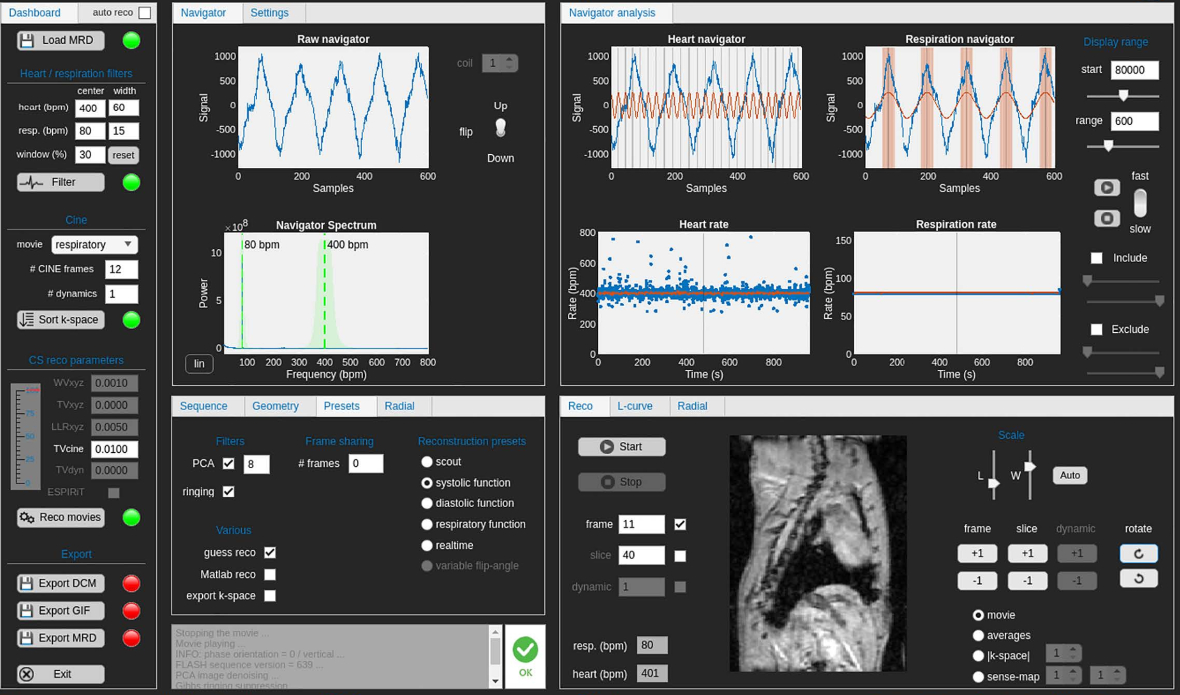 Video: 3D Cine Magnetic Resonance Imaging of Respiratory Motion in ...