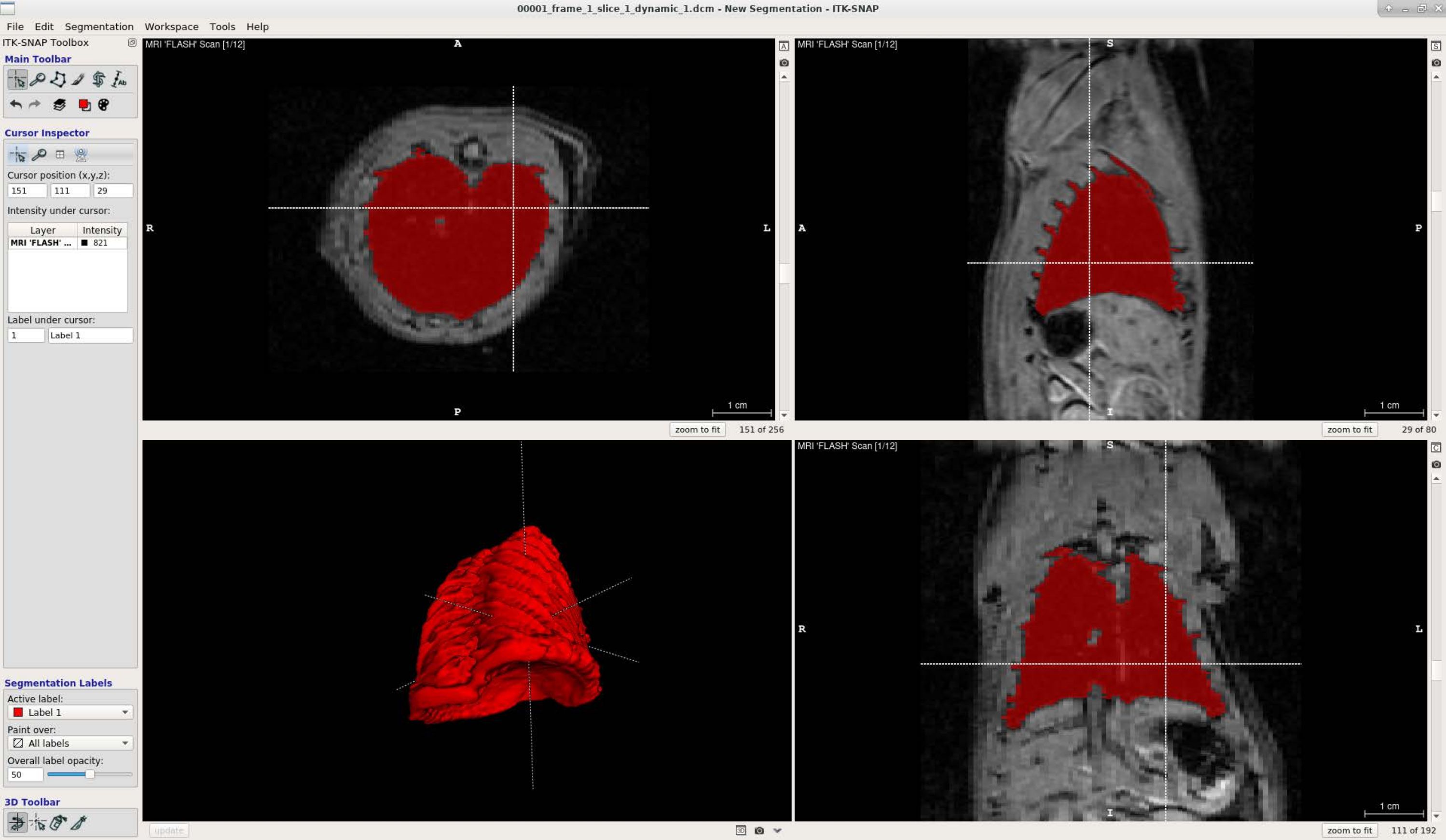 Video: 3D Cine Magnetic Resonance Imaging of Respiratory Motion in ...
