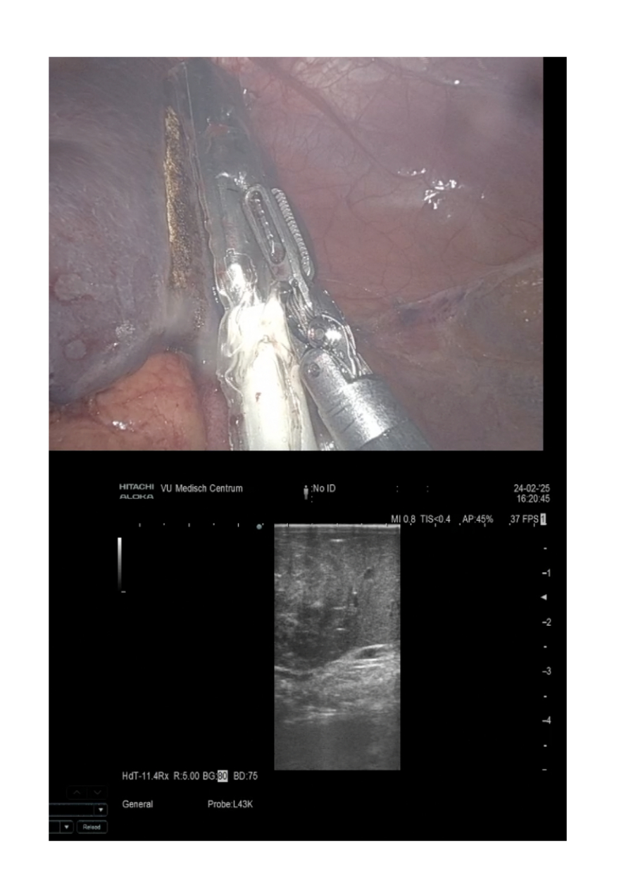 Robot-assisted Partial Splenectomy