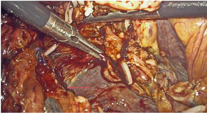 Laparoscopic Radical Resection for Hilar Cholangiocarcinoma with Portal ...
