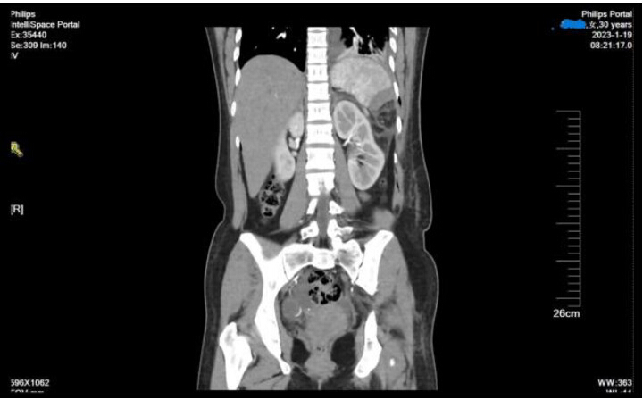 How to Preserve the Spleen: Laparoscopic Partial Splenectomy as a ...