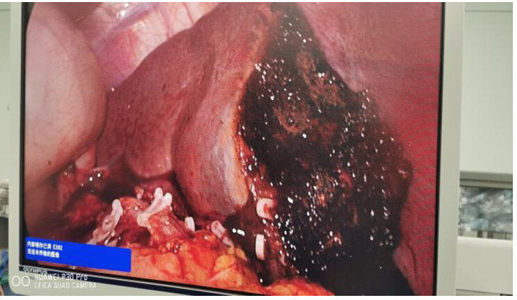 How to Preserve the Spleen: Laparoscopic Partial Splenectomy as a ...