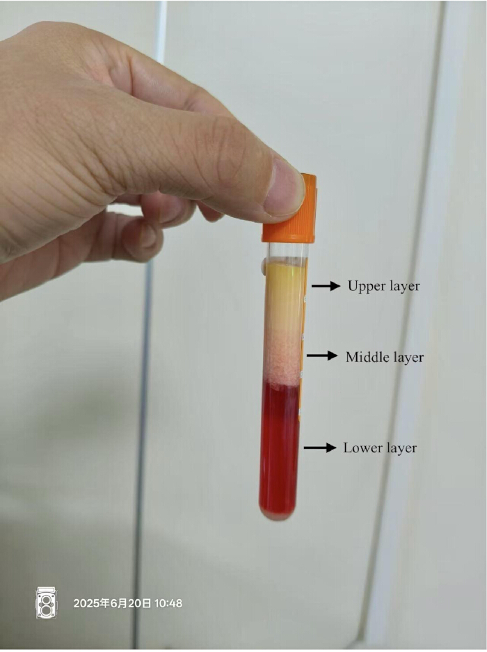 Mechanical Processing of SVF-Enriched Microfat for Reconstruction of ...